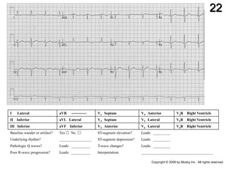 DISKUSI KASUS EKG DASAR 12 LEAD - KUNCI(edit).pdf