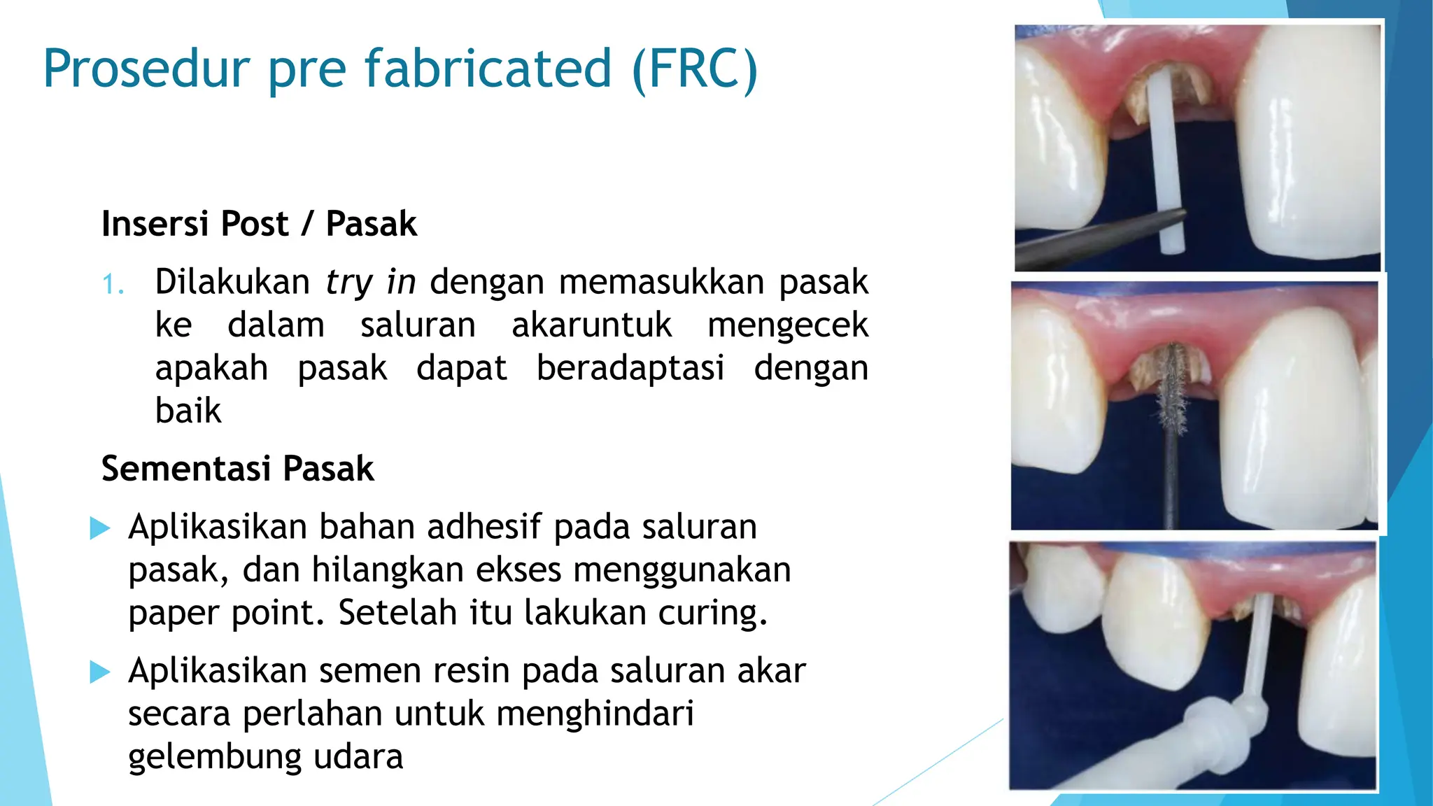 diskusi pasak dan mahkota jaket psa gigi | PPTX