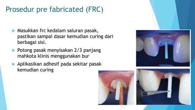 diskusi pasak dan mahkota jaket psa gigi | PPTX