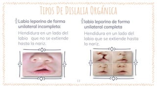 Dislalia | PPTX