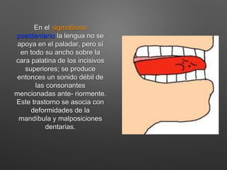 Dislalia, Fonoaudiología, Ortodoncia, Psicología | PPTX