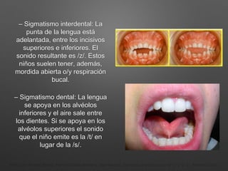 Dislalia, Fonoaudiología, Ortodoncia, Psicología | PPTX