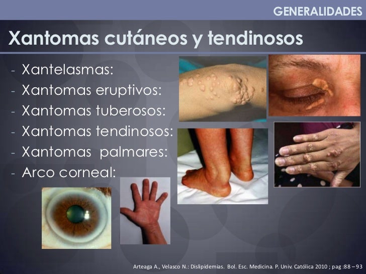 Xantelasmas Ou Xantomas Causas Sinais Tratamento