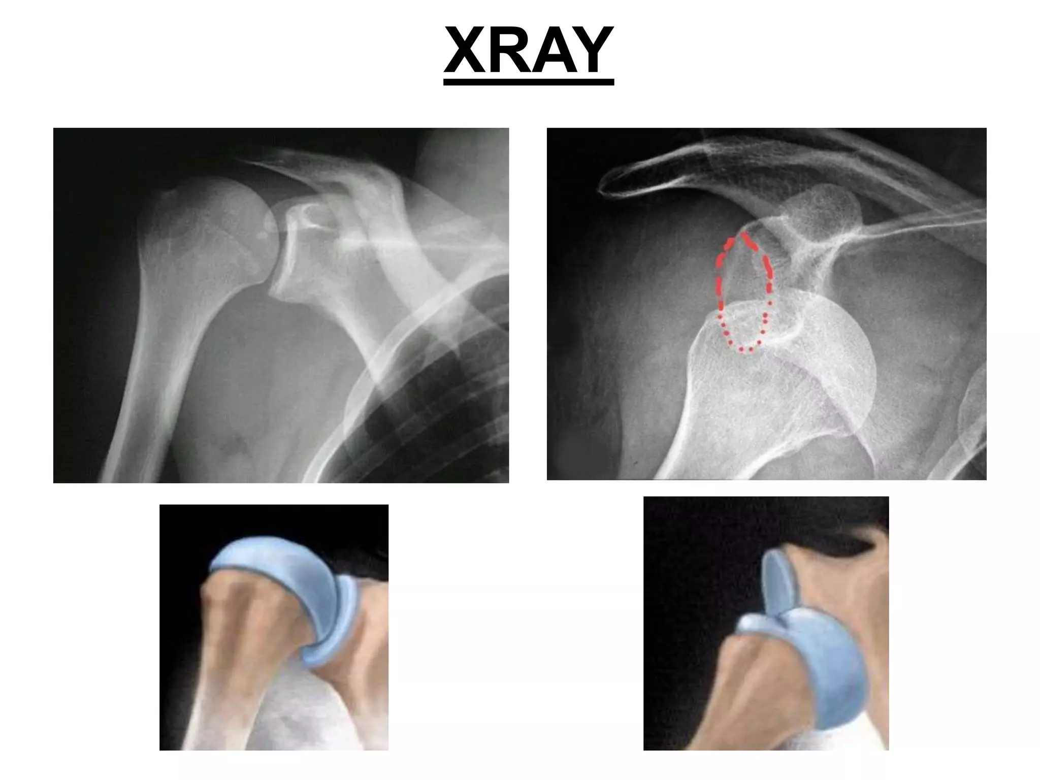 Joint Dislocation | PPTX