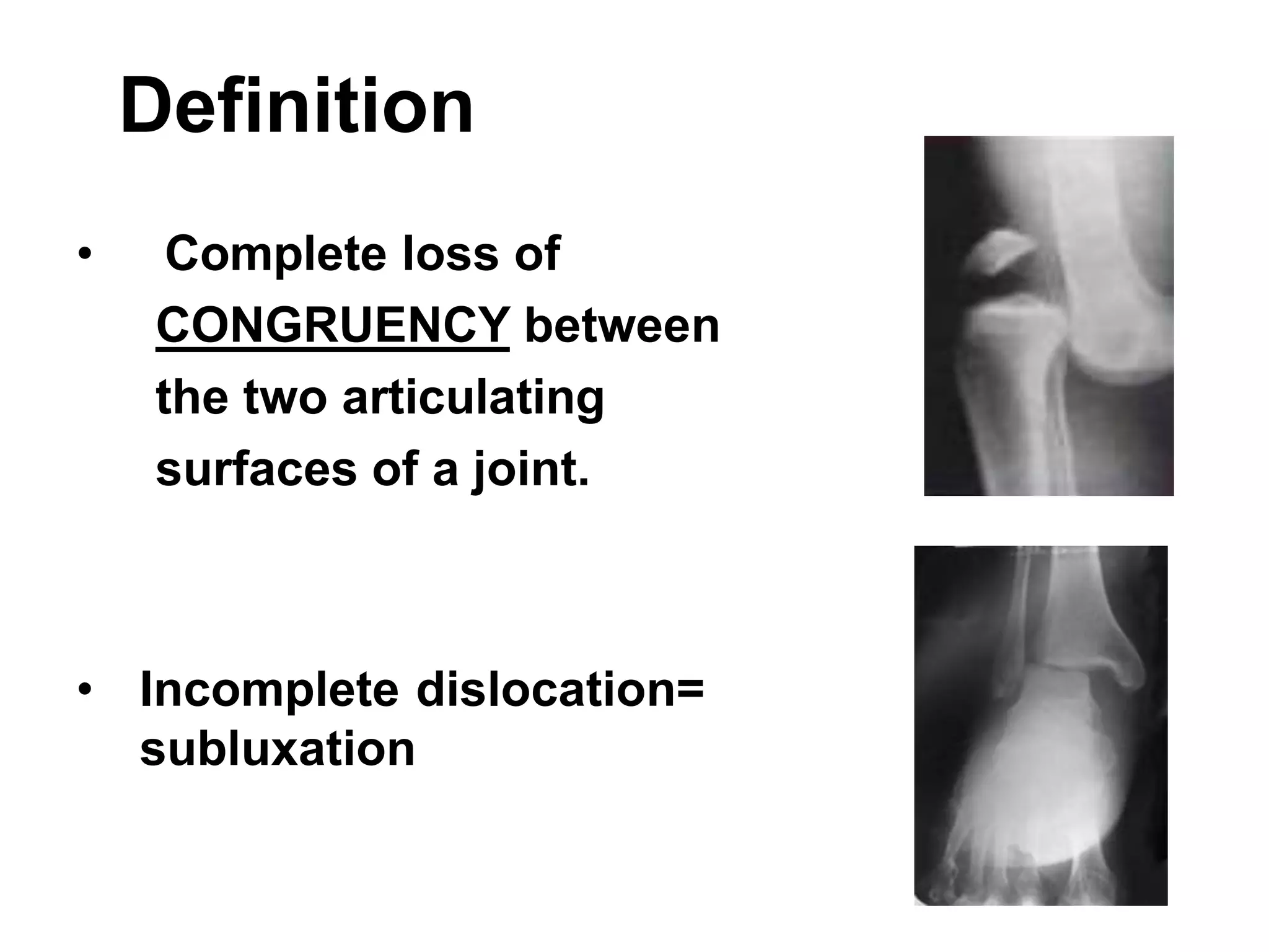 Joint Dislocation | PPTX