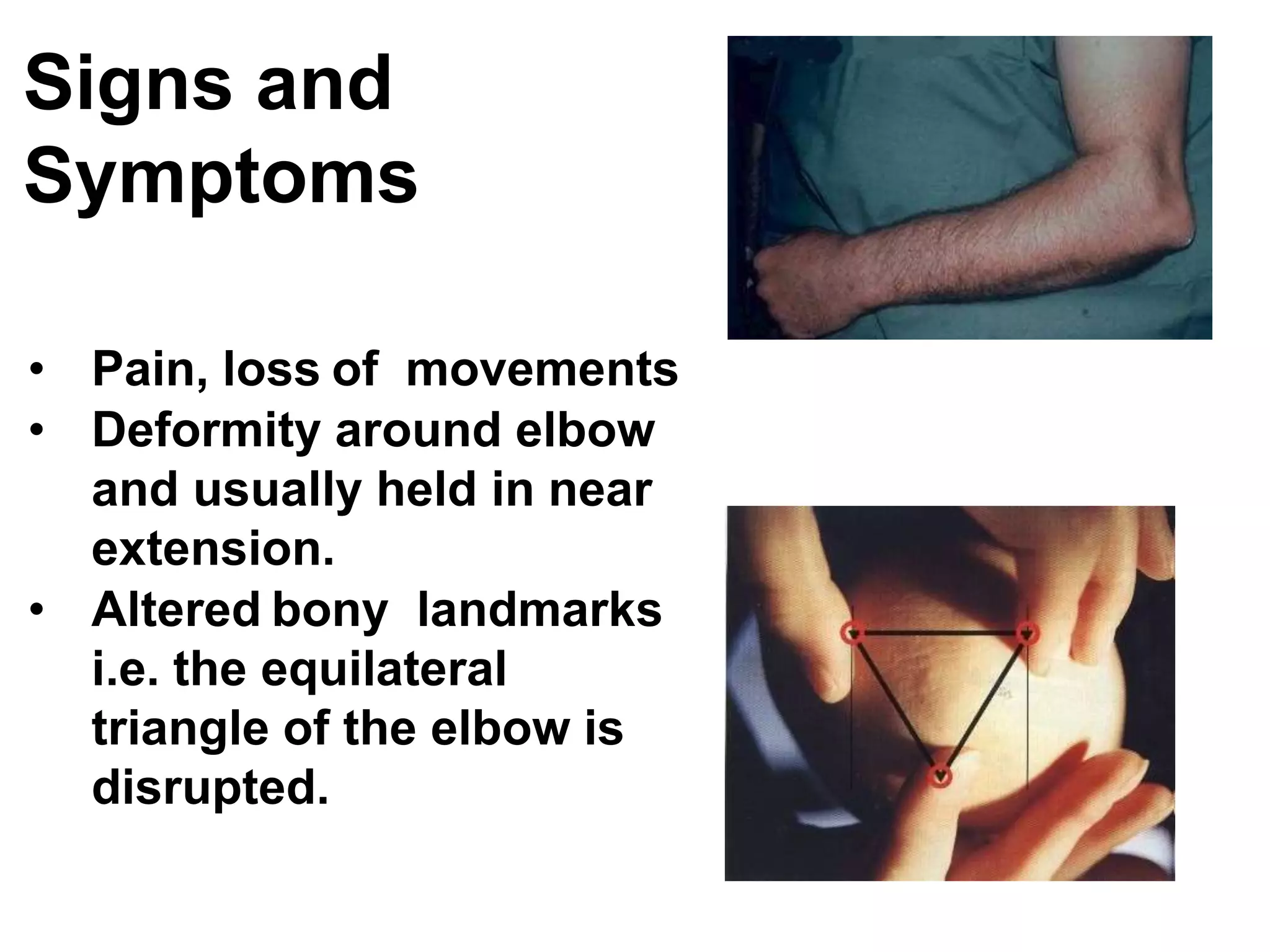 Joint Dislocation | PPTX