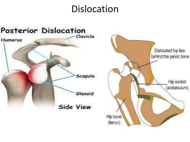 Dislocation.pptx | Death, Injury, or Military Conflict | Sensitive Topics