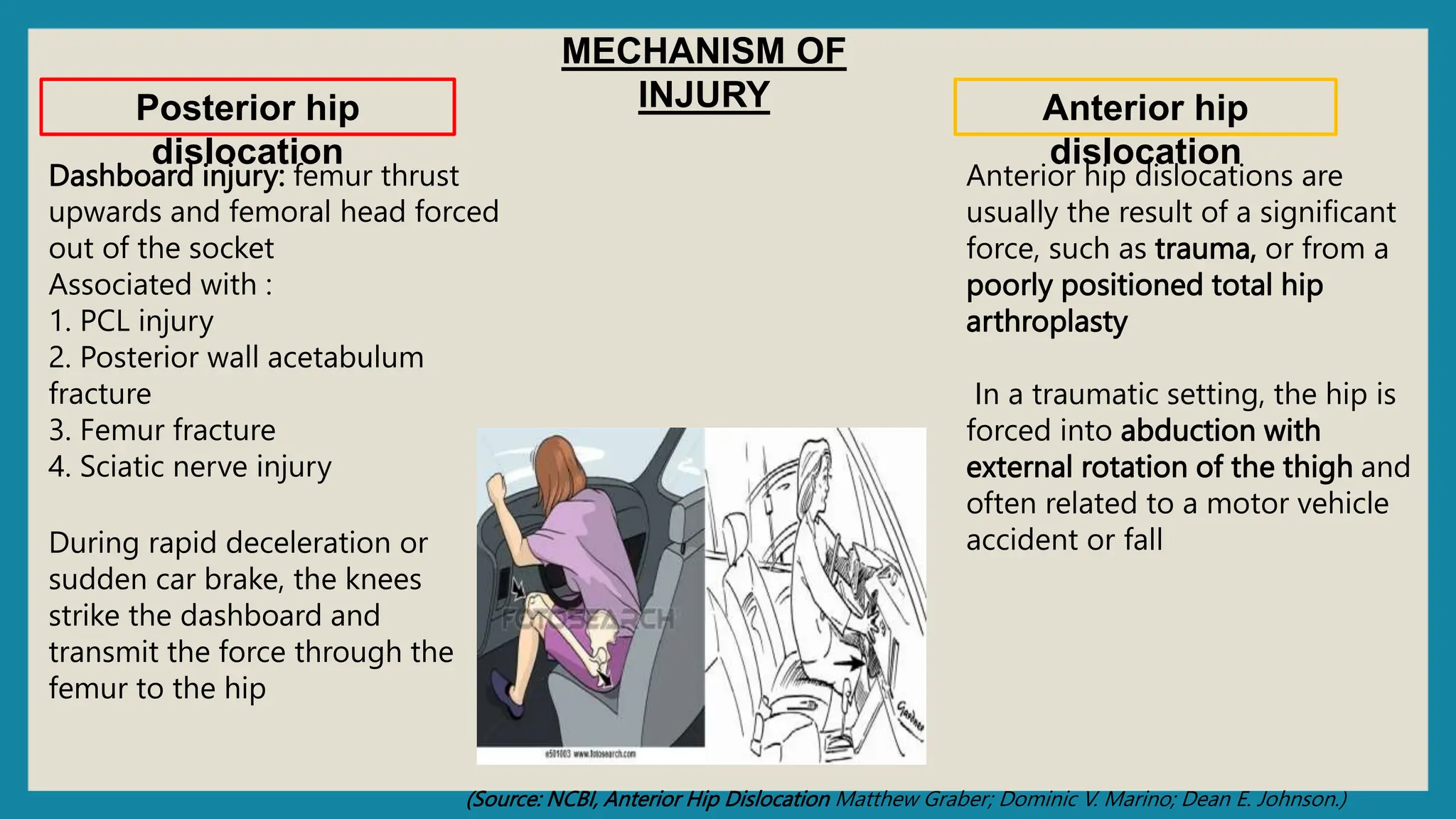 hip, shoulder and elbow dislocation.pptx