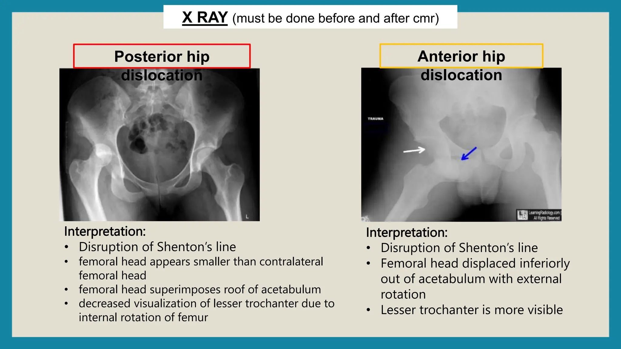 hip, shoulder and elbow dislocation.pptx