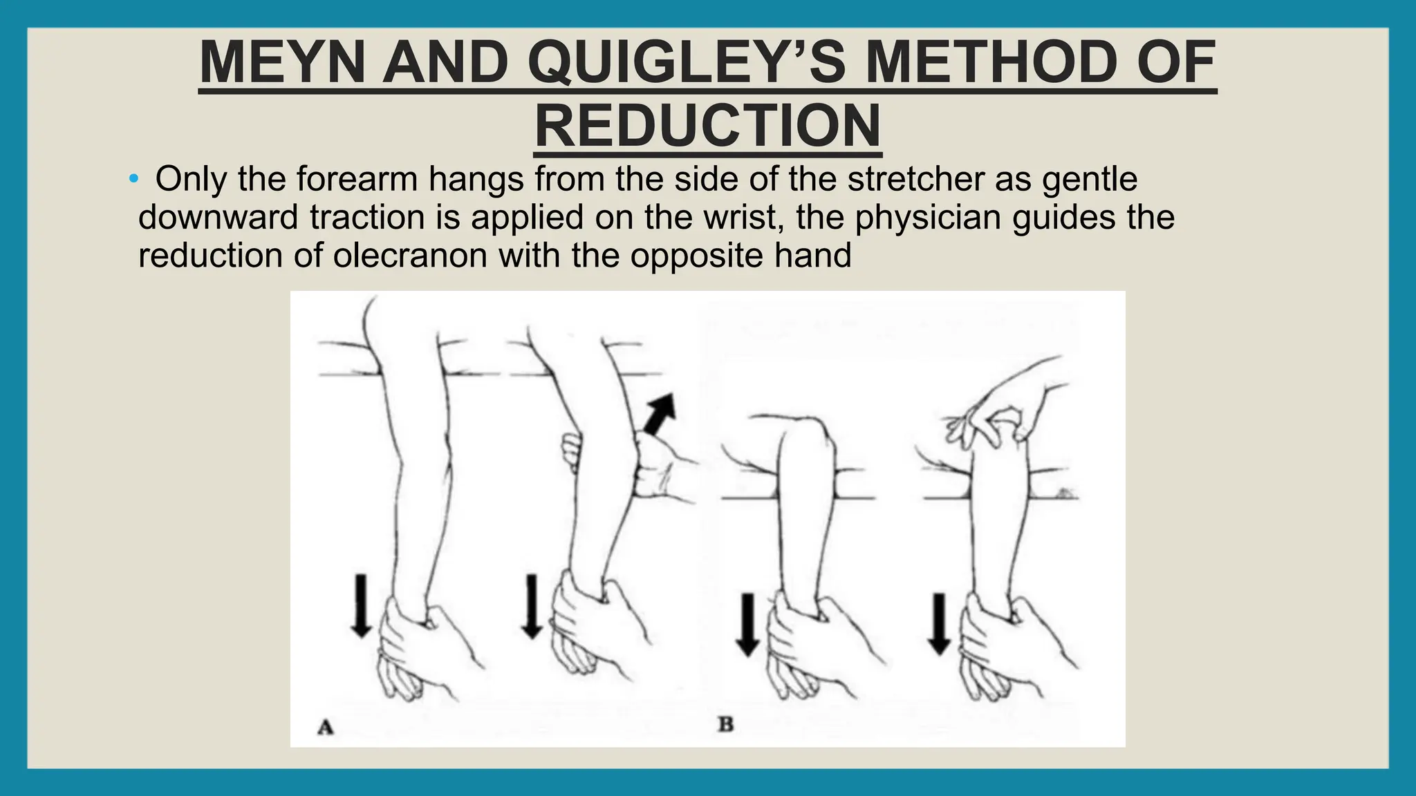 hip, shoulder and elbow dislocation.pptx