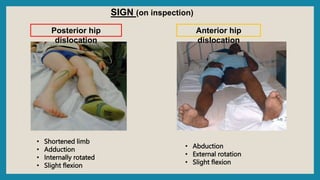 hip, shoulder and elbow dislocation.pptx