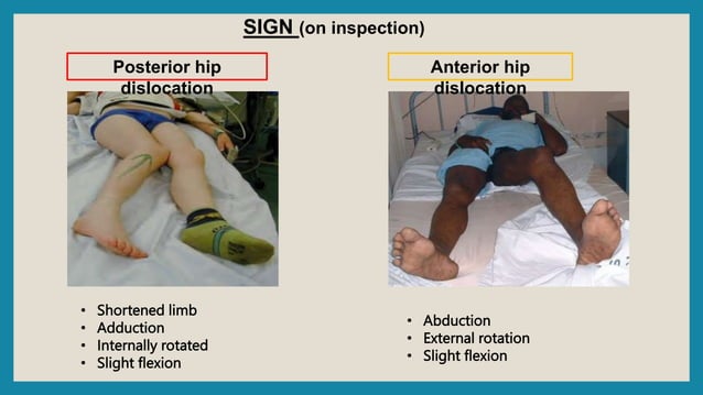 hip, shoulder and elbow dislocation.pptx