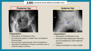 hip, shoulder and elbow dislocation.pptx