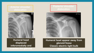 hip, shoulder and elbow dislocation.pptx