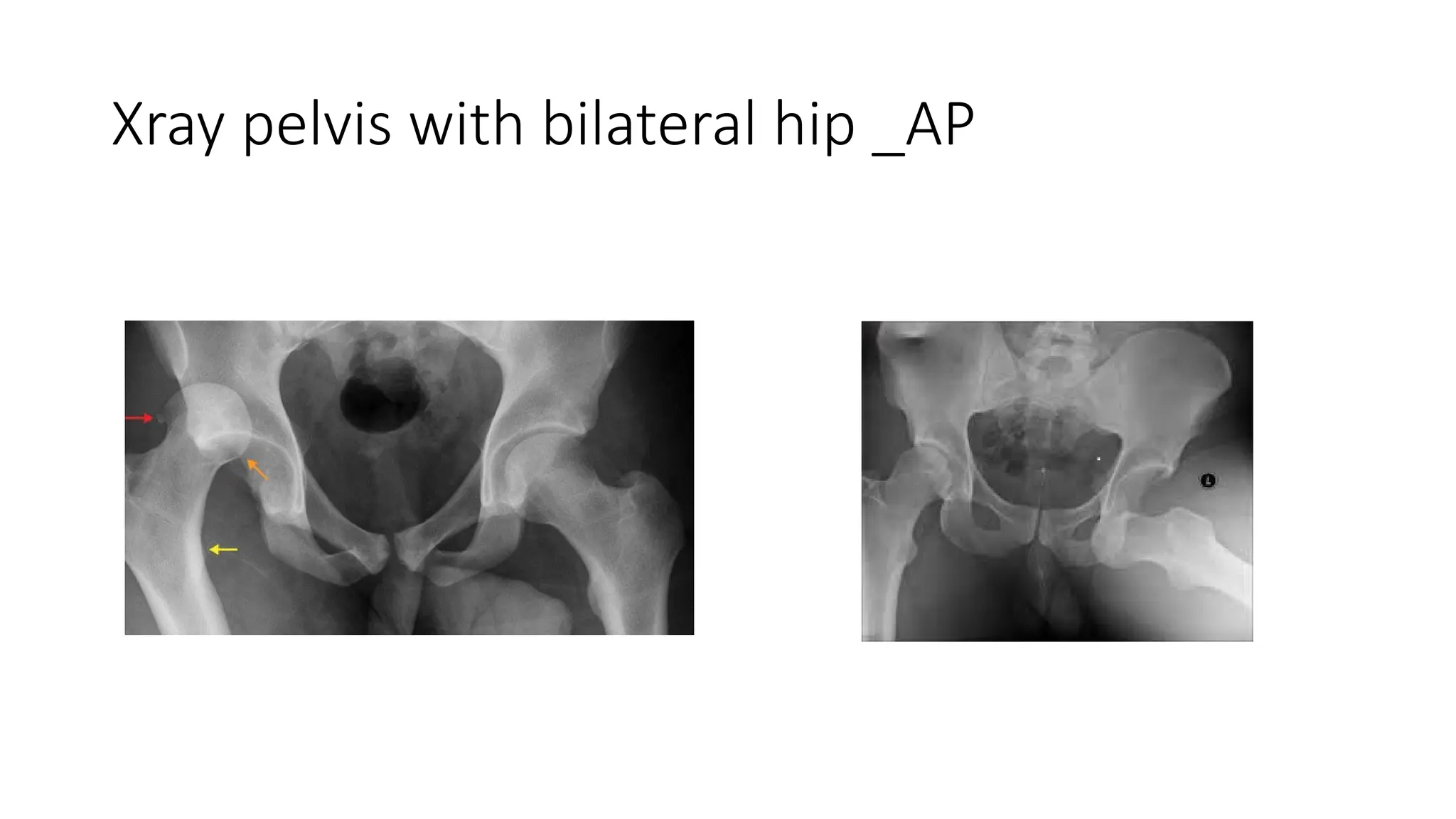 management of shoulder and hip dislocation.pptx
