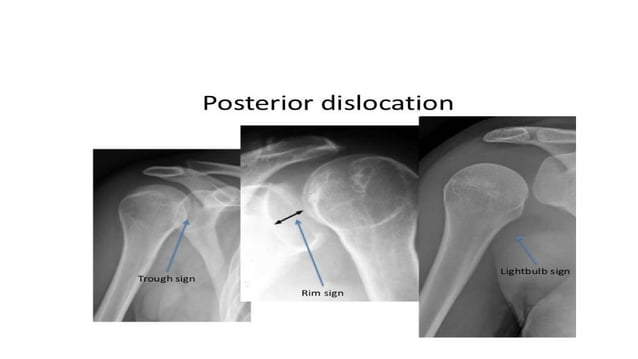 Dislocation OF DIFFERENT JOINTS .pptx