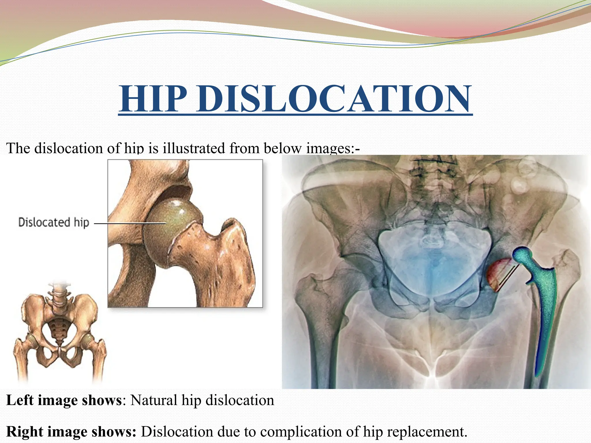 DISLOCATION AND BONE INJURIES (extremities) | PPTX