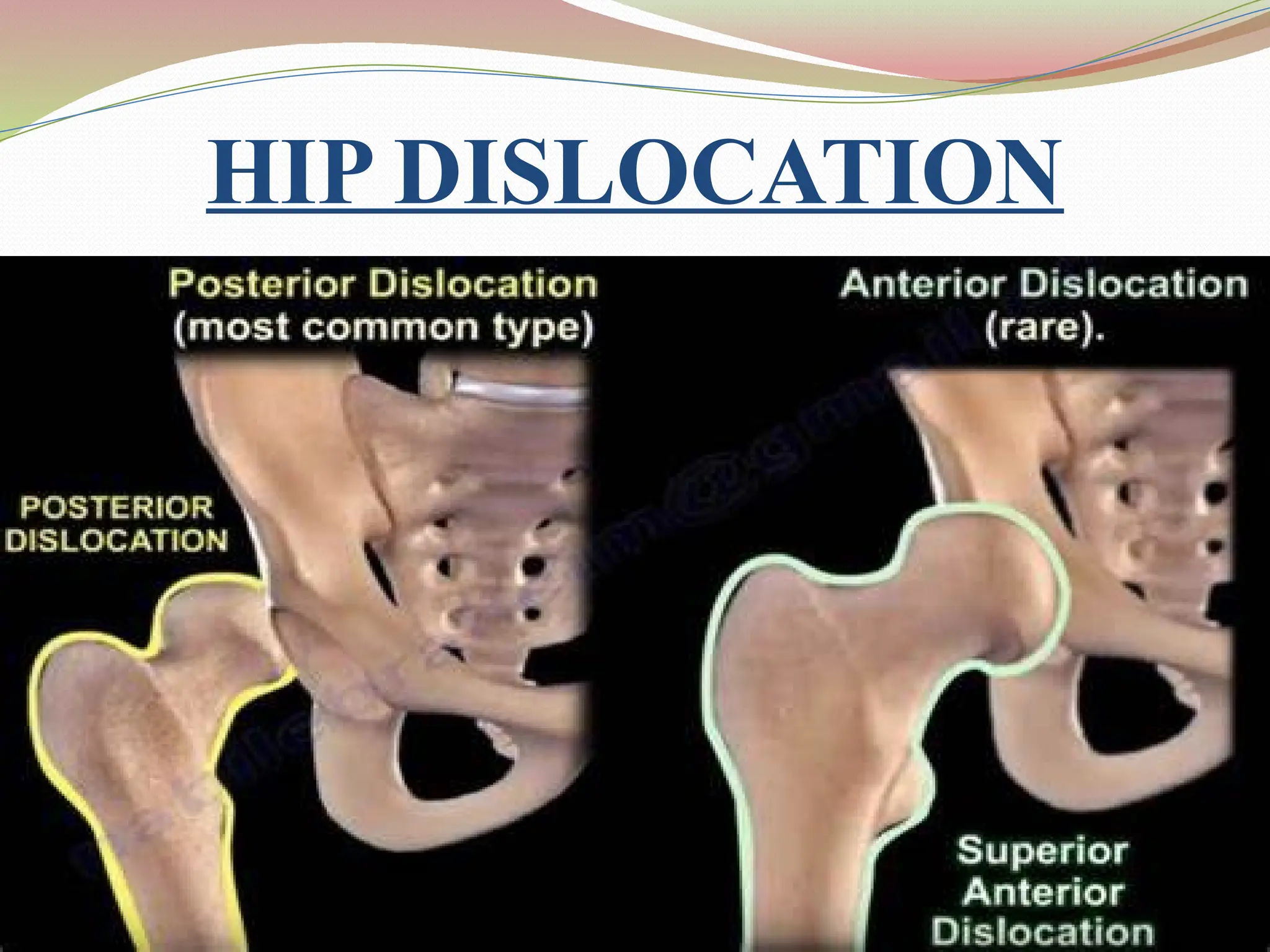 DISLOCATION AND BONE INJURIES (extremities) | PPTX