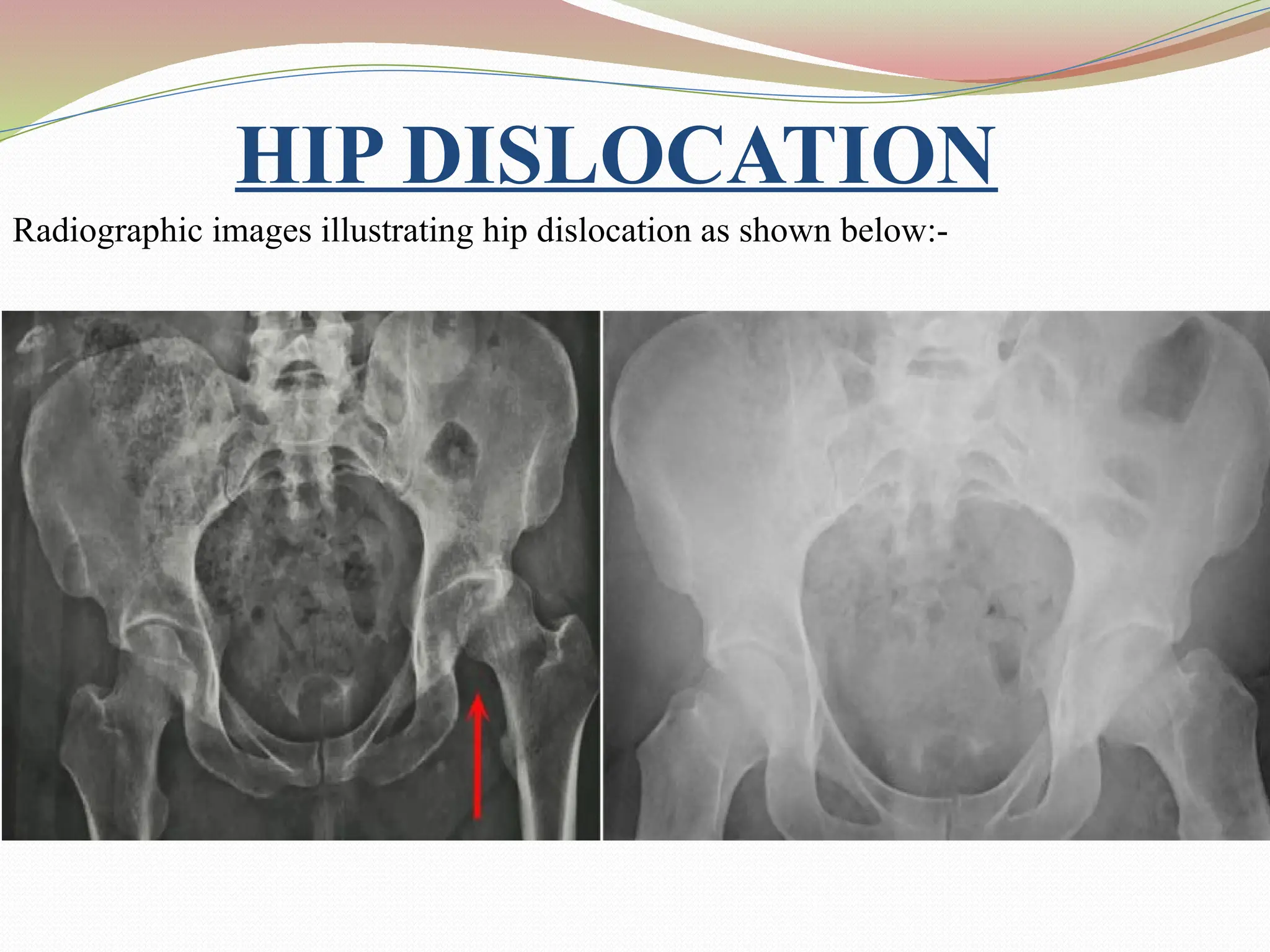 DISLOCATION AND BONE INJURIES (extremities) | PPTX
