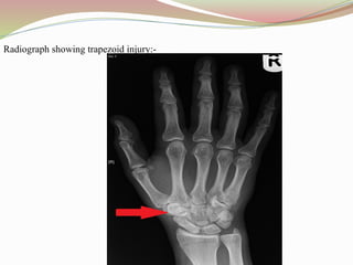 DISLOCATION AND BONE INJURIES (extremities) | PPTX