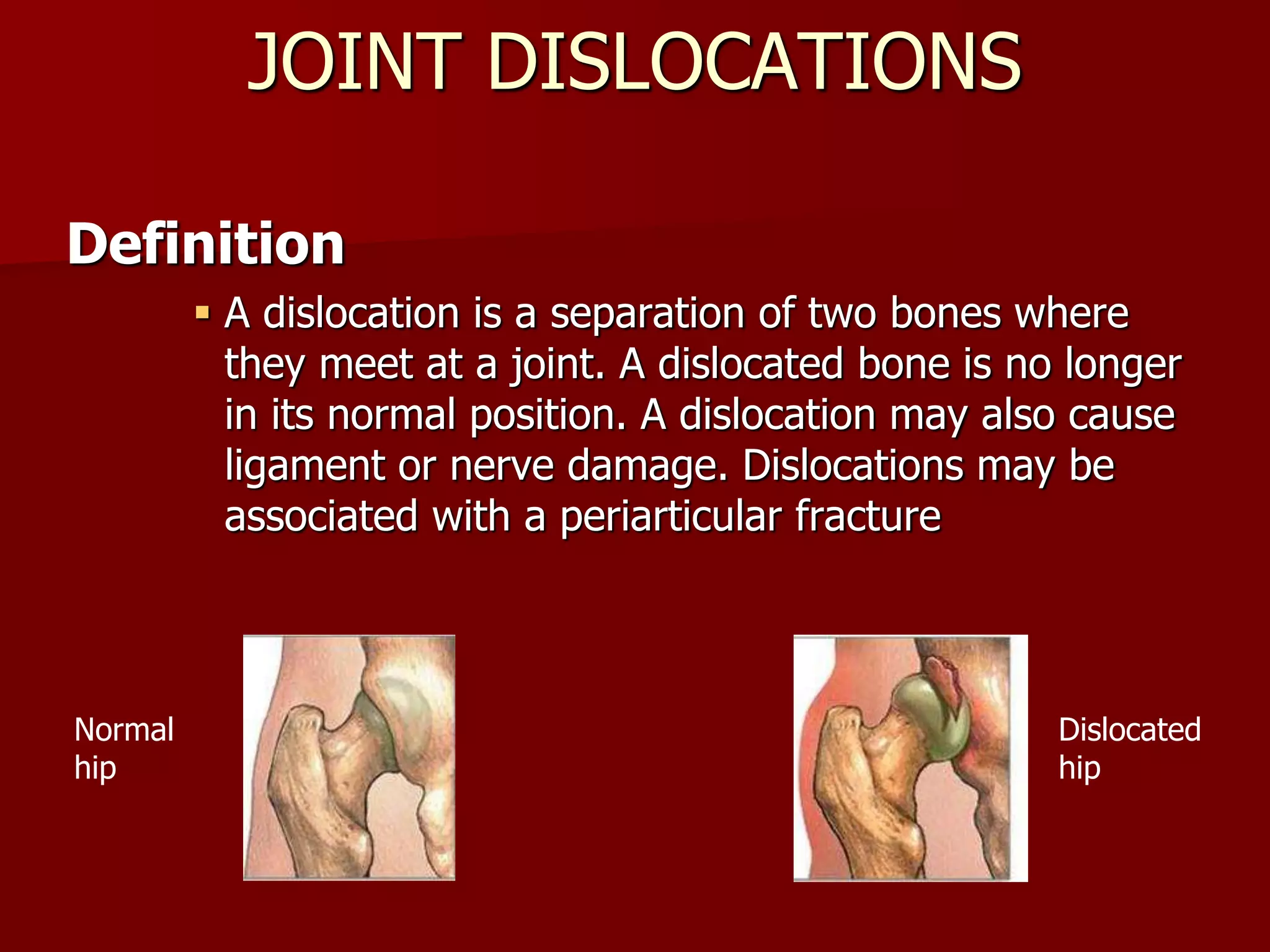 dislocation and subluxation 3.ppt