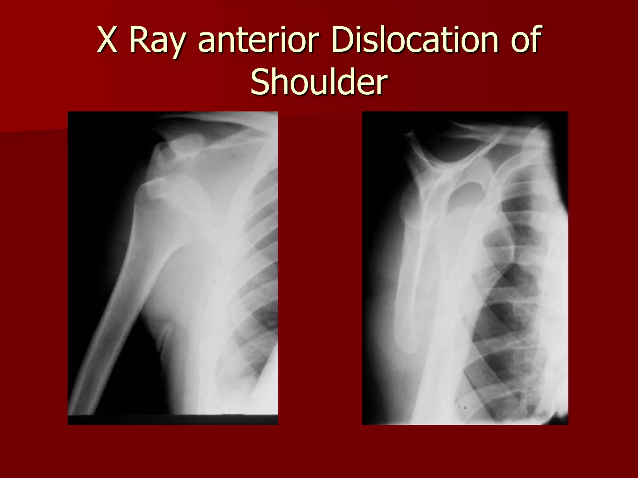 dislocation and subluxation 3.ppt