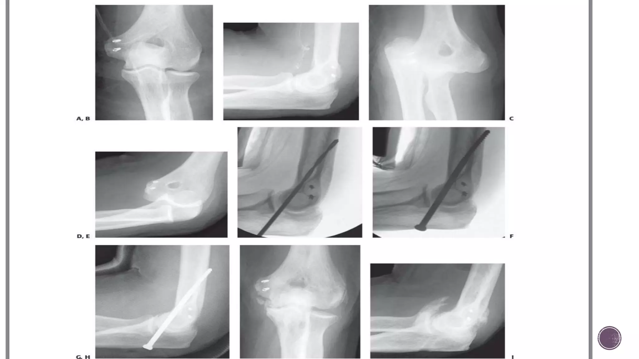 Dislocation & fracture of elbow | PPTX