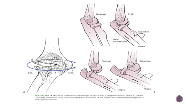 Dislocation & fracture of elbow | PPTX