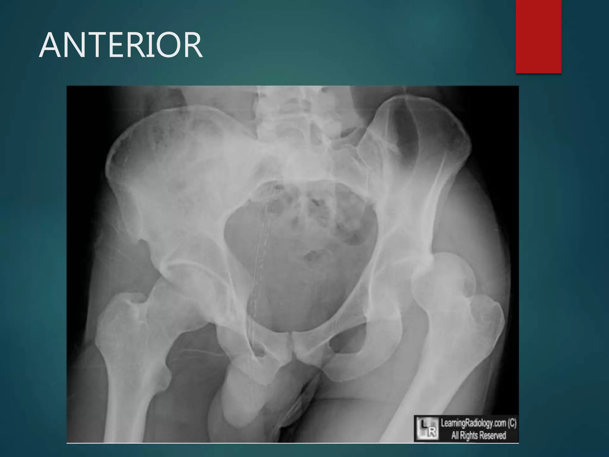 Dislocation of hip | PPTX