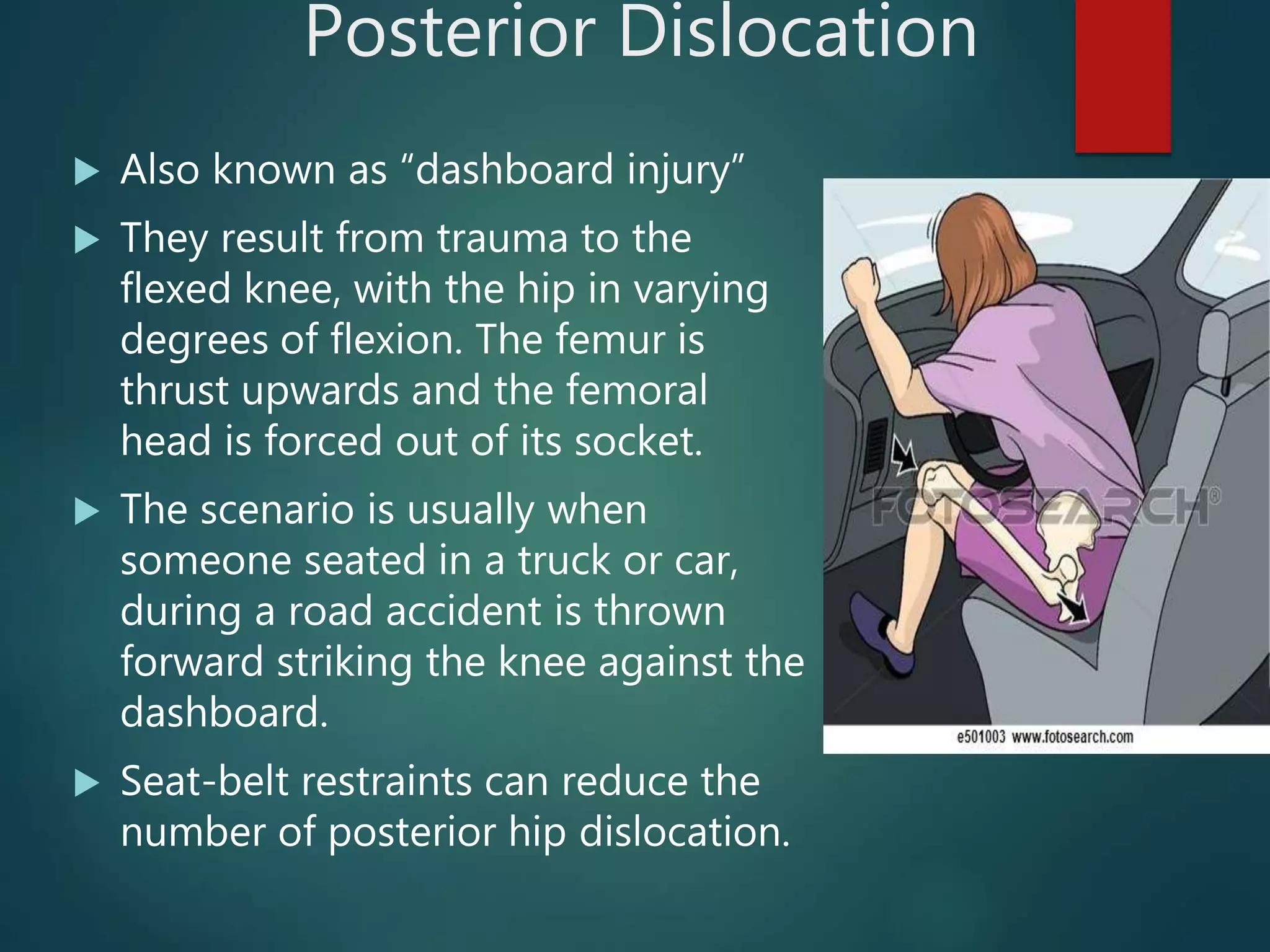 Dislocation of hip | PPTX