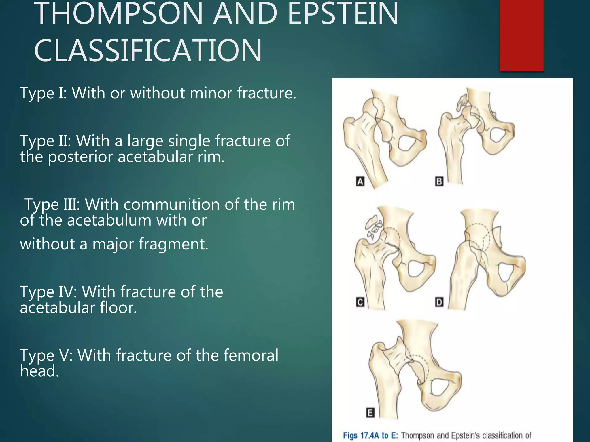 Dislocation of hip | PPTX