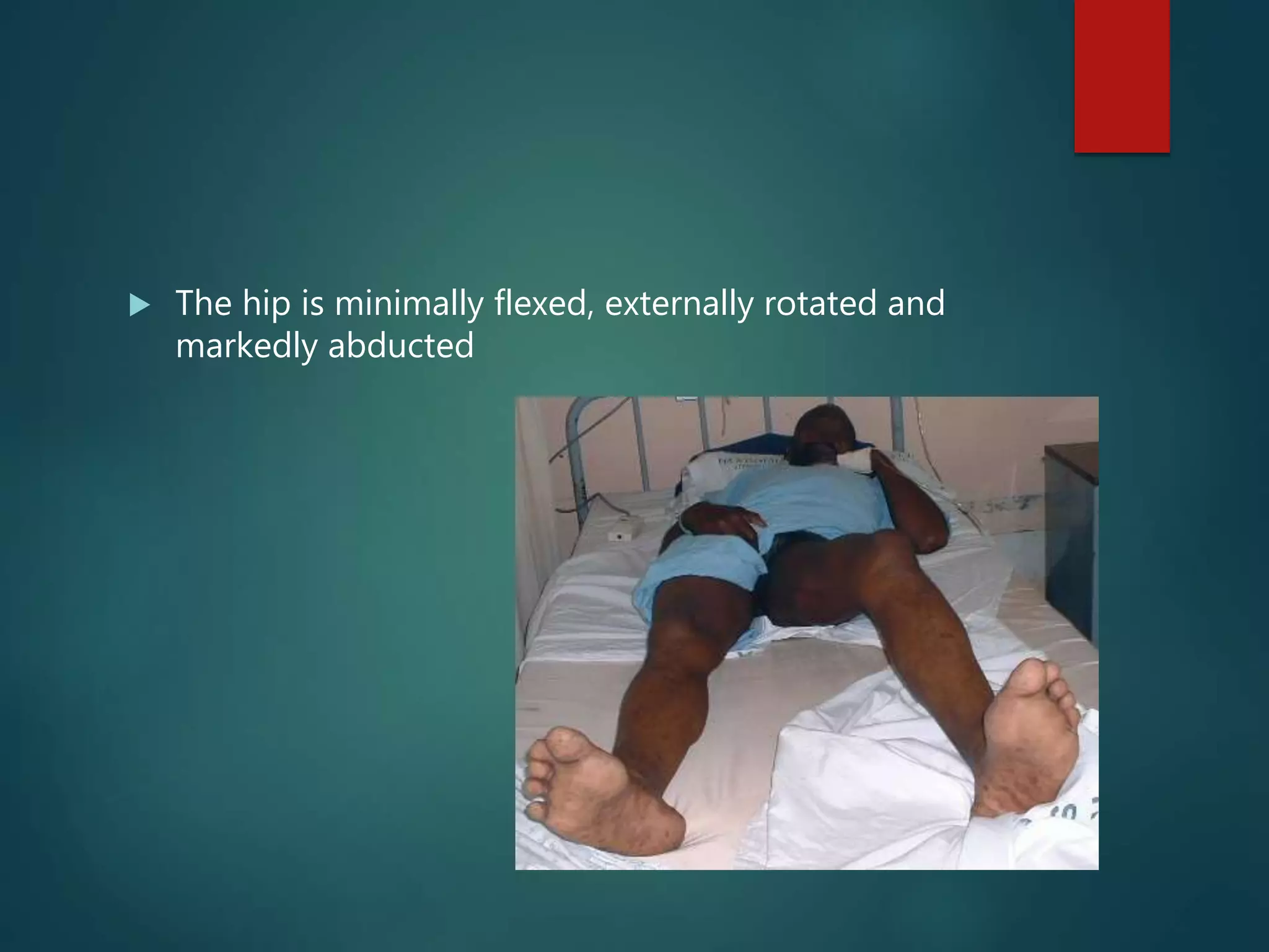 Dislocation of hip | PPTX