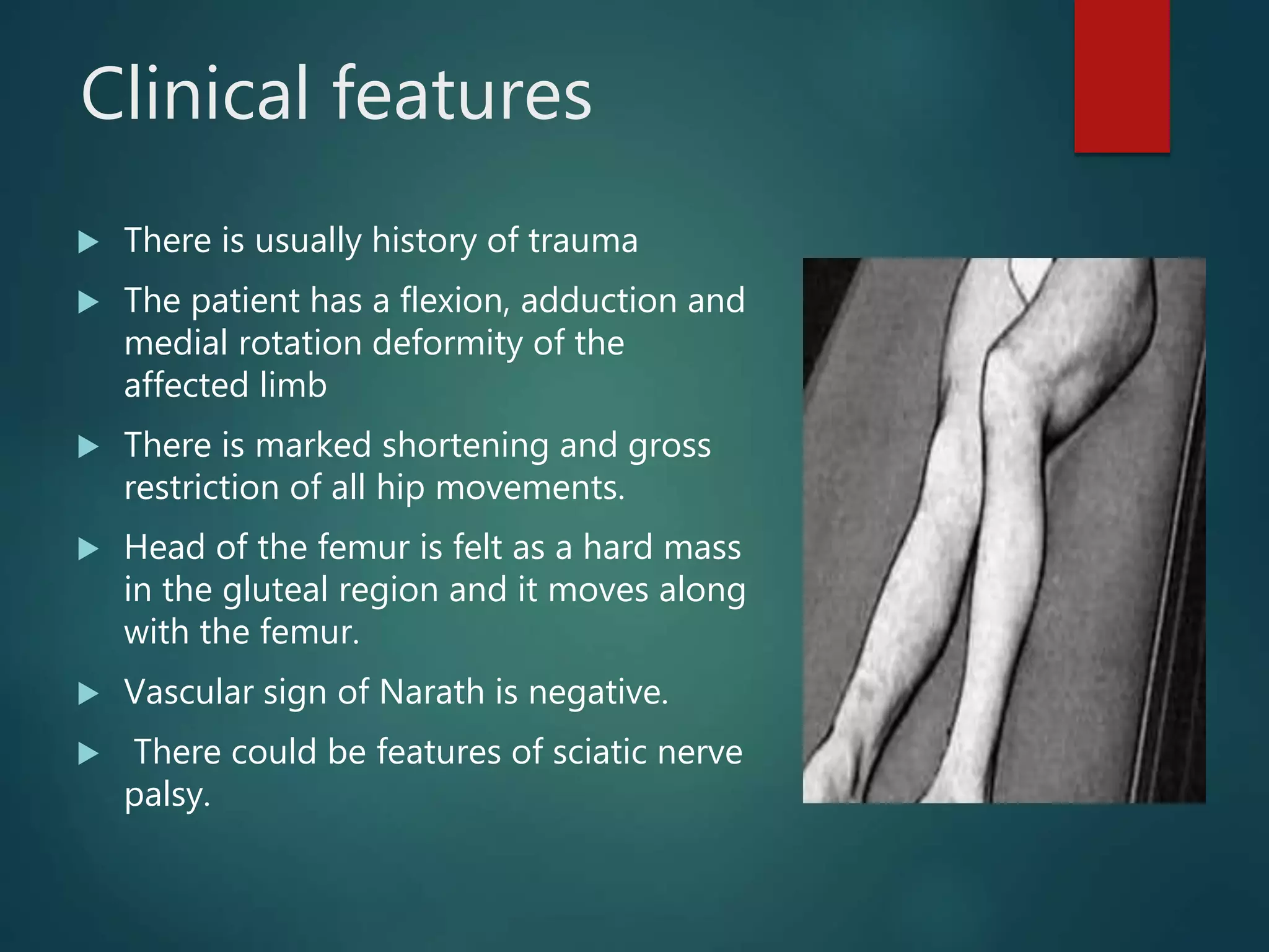 Dislocation of hip | PPTX