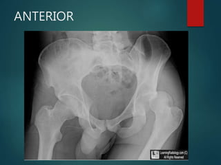 Dislocation of hip | PPT