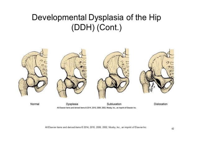 Dislocation of hip | PPTX | Pregnancy | Reproductive Health