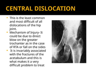 dislocation of hip in adultss class.pptx | Death, Injury, or Military ...