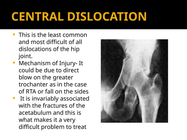 dislocation of hip in adultss class.pptx | Death, Injury, or Military Conflict | Sensitive Topics