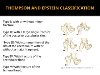 dislocation of hip in adultss class.pptx | Death, Injury, or Military ...