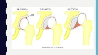 Dislocation of hip joint | PPTX