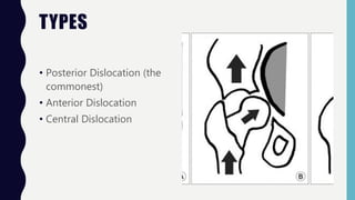 Dislocation of hip joint | PPTX