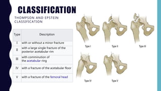 Dislocation of hip joint | PPTX