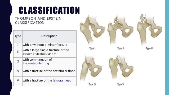 Dislocation of hip joint