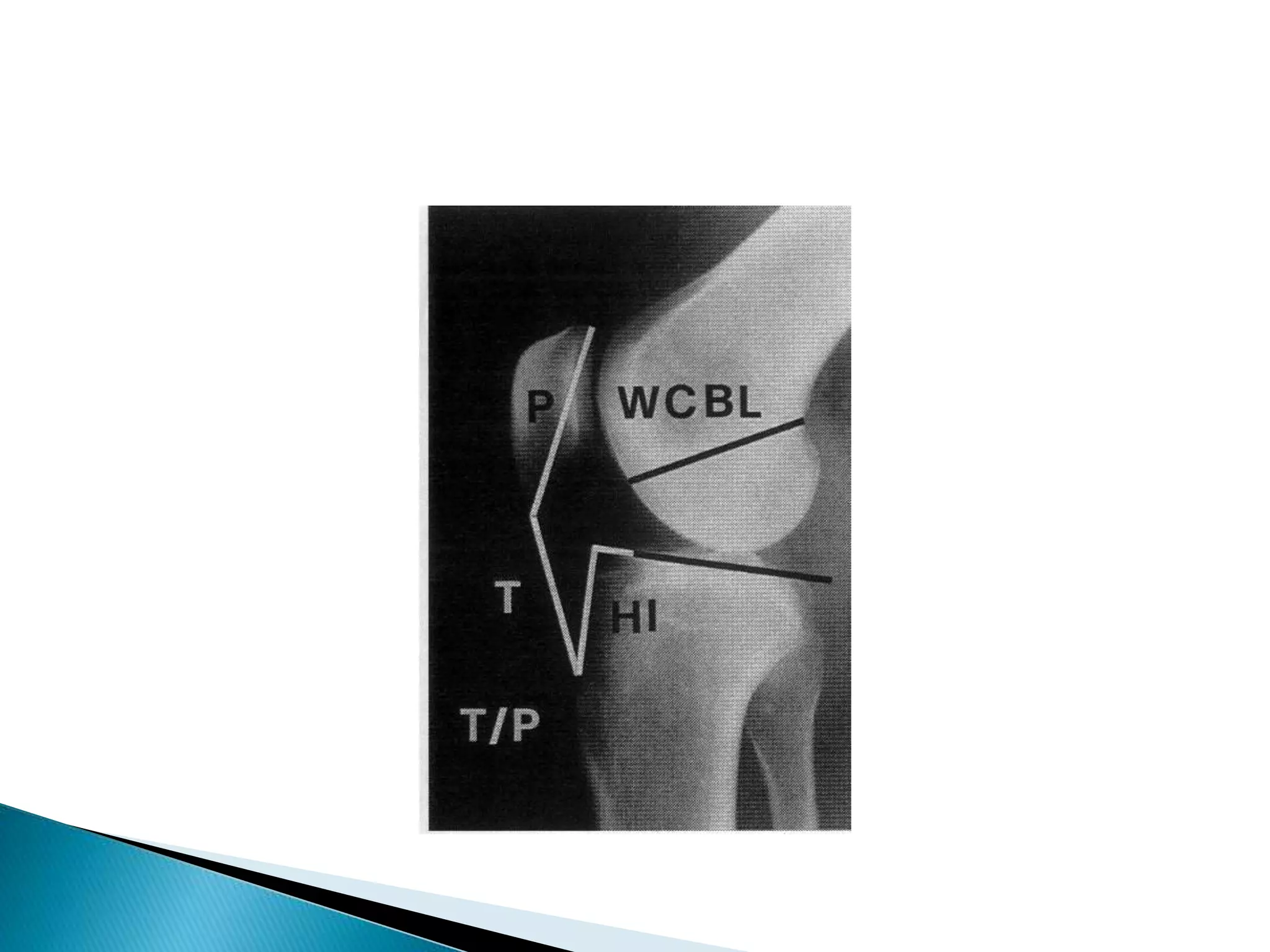 Dislocation of patella | PPTX