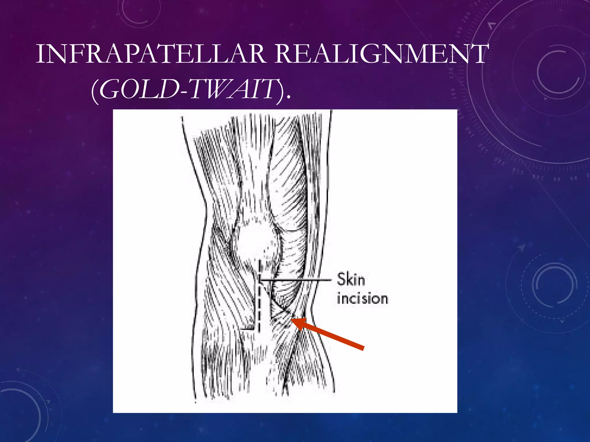 Recurrent Dislocation of patella -PAWAN | PPT