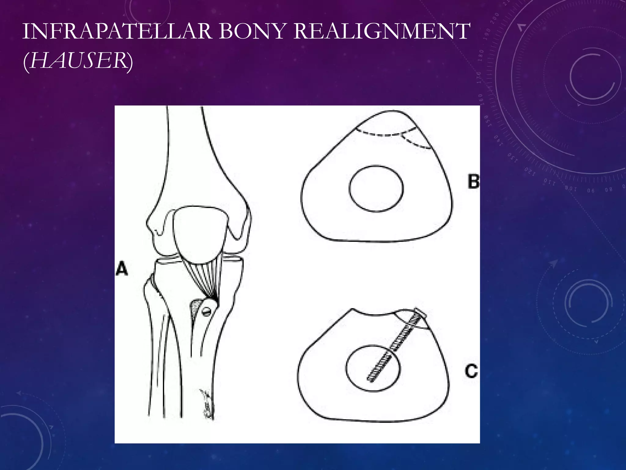 Recurrent Dislocation of patella -PAWAN | PPT