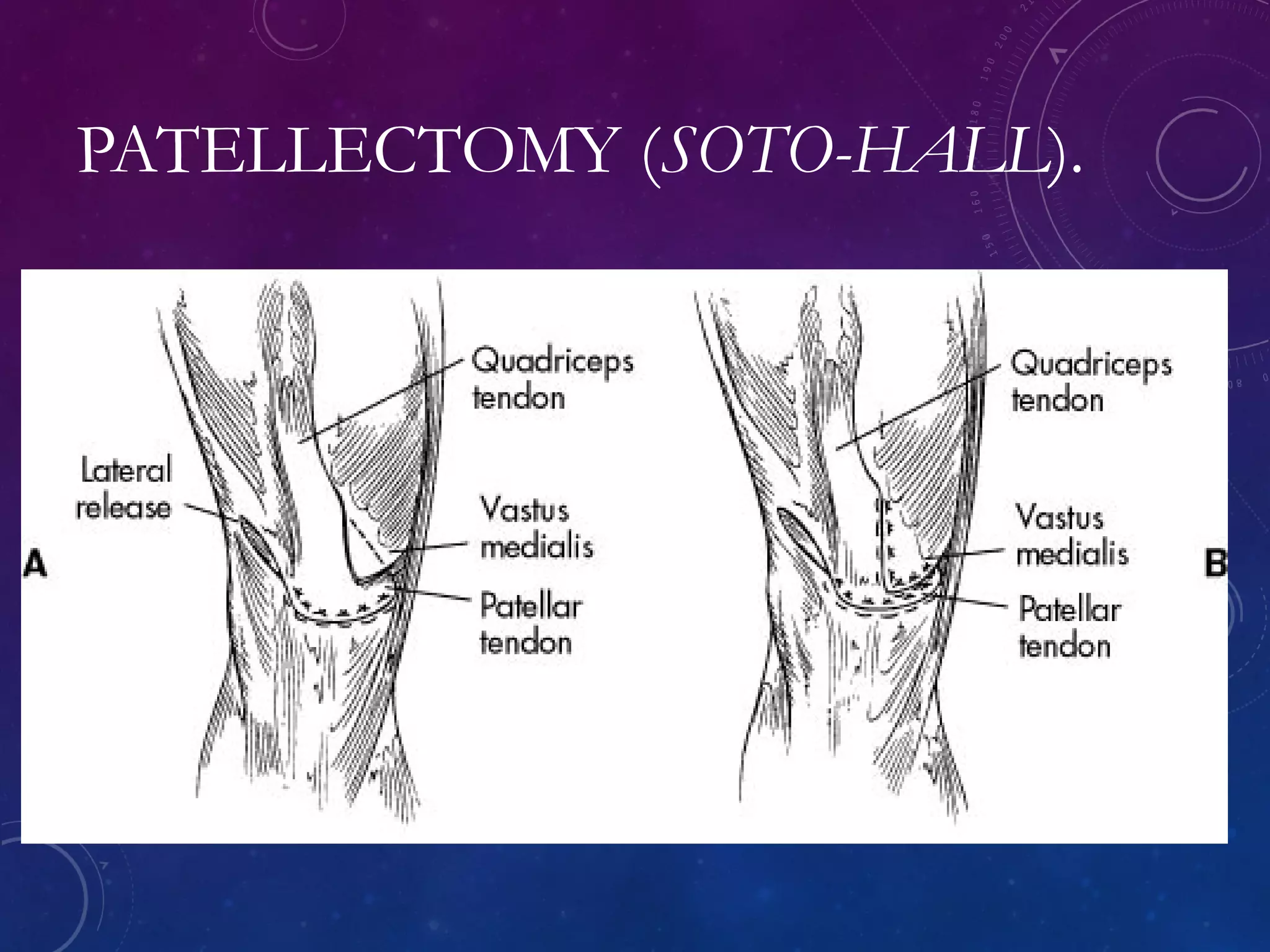 Recurrent Dislocation of patella -PAWAN | PPT
