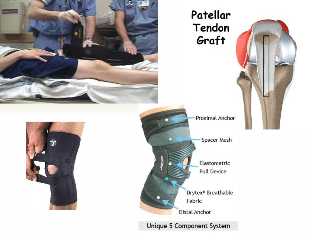 Dislocation of patella