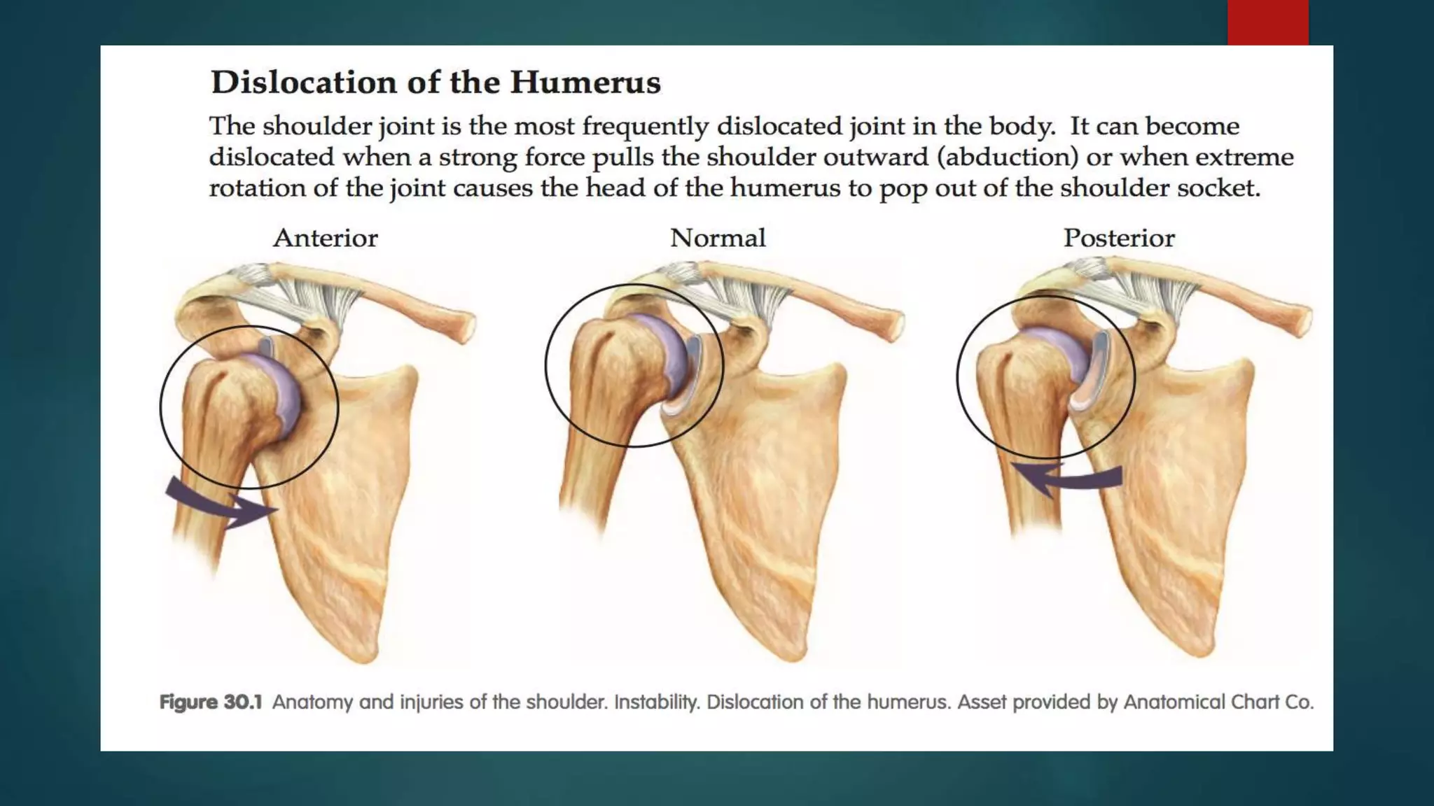 Dislocation of shoulder мөрний мултрал | PPTX