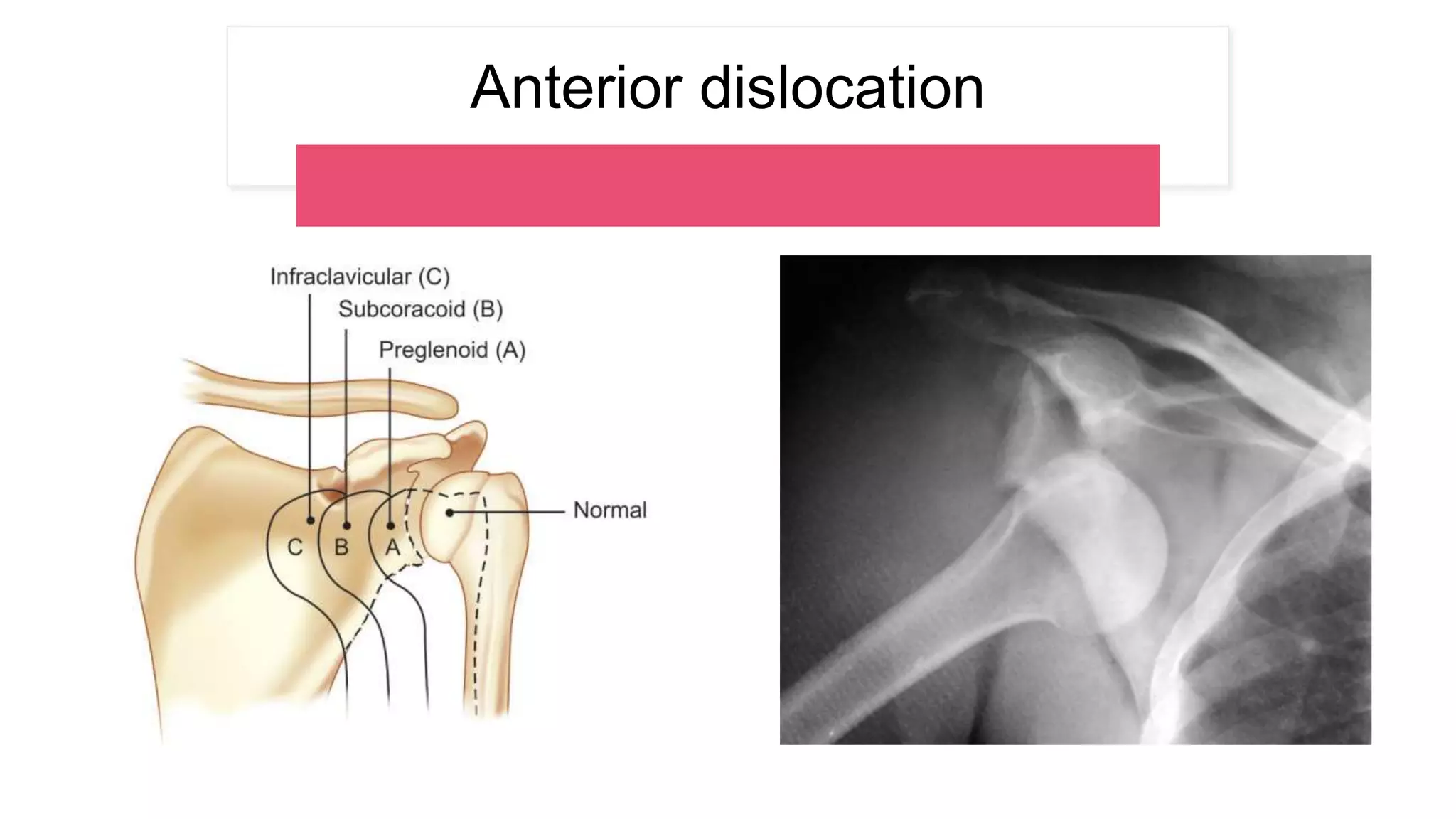 Dislocation of the shoulder | PPTX