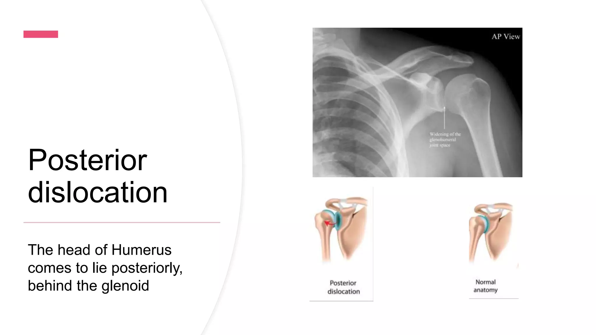 Dislocation of the shoulder | PPTX